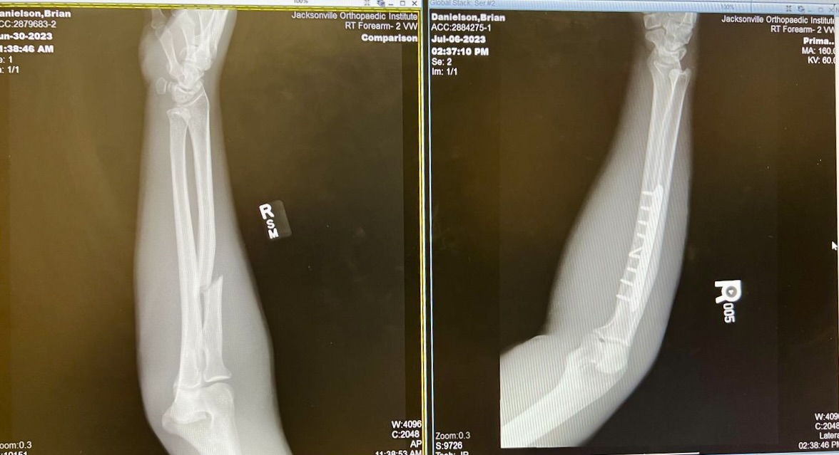 Bryan Danielson on 'road to recovery' after surgery that involved steel ...